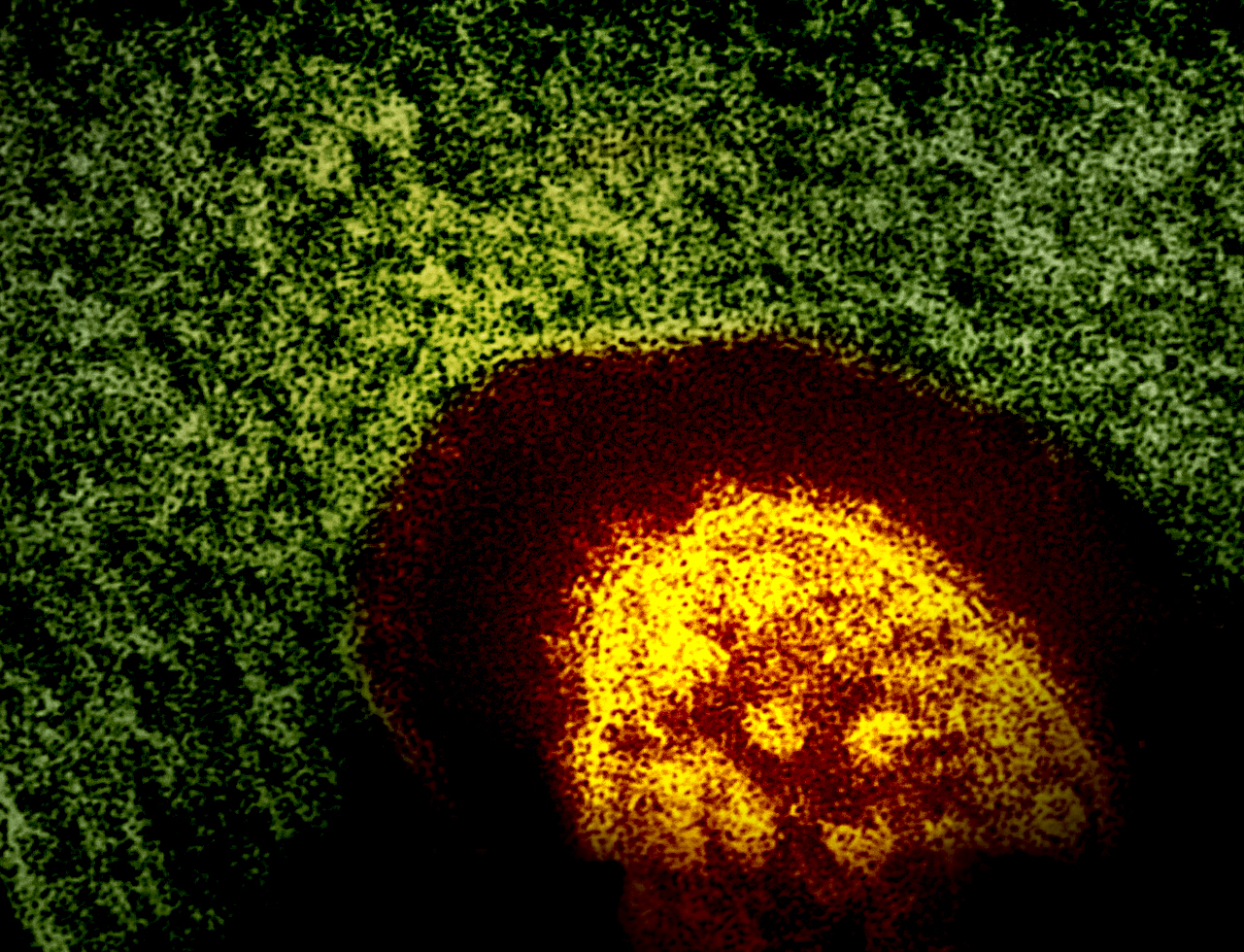 Measles_CDC - North Carolina Health News